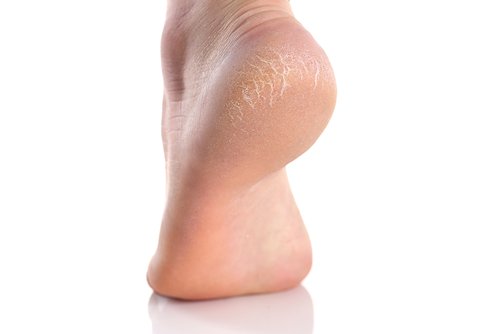 Cómo curar los talones agrietados sin esfuerzo