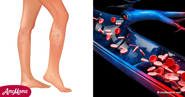 Early Blood Clot Signs and Symptoms Everyone Needs to Know About