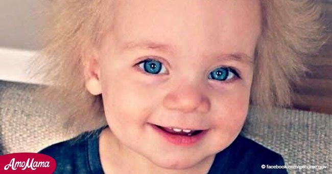 Esta niña tiene una anomalía genética llamada "síndrome de pelo impeinable"