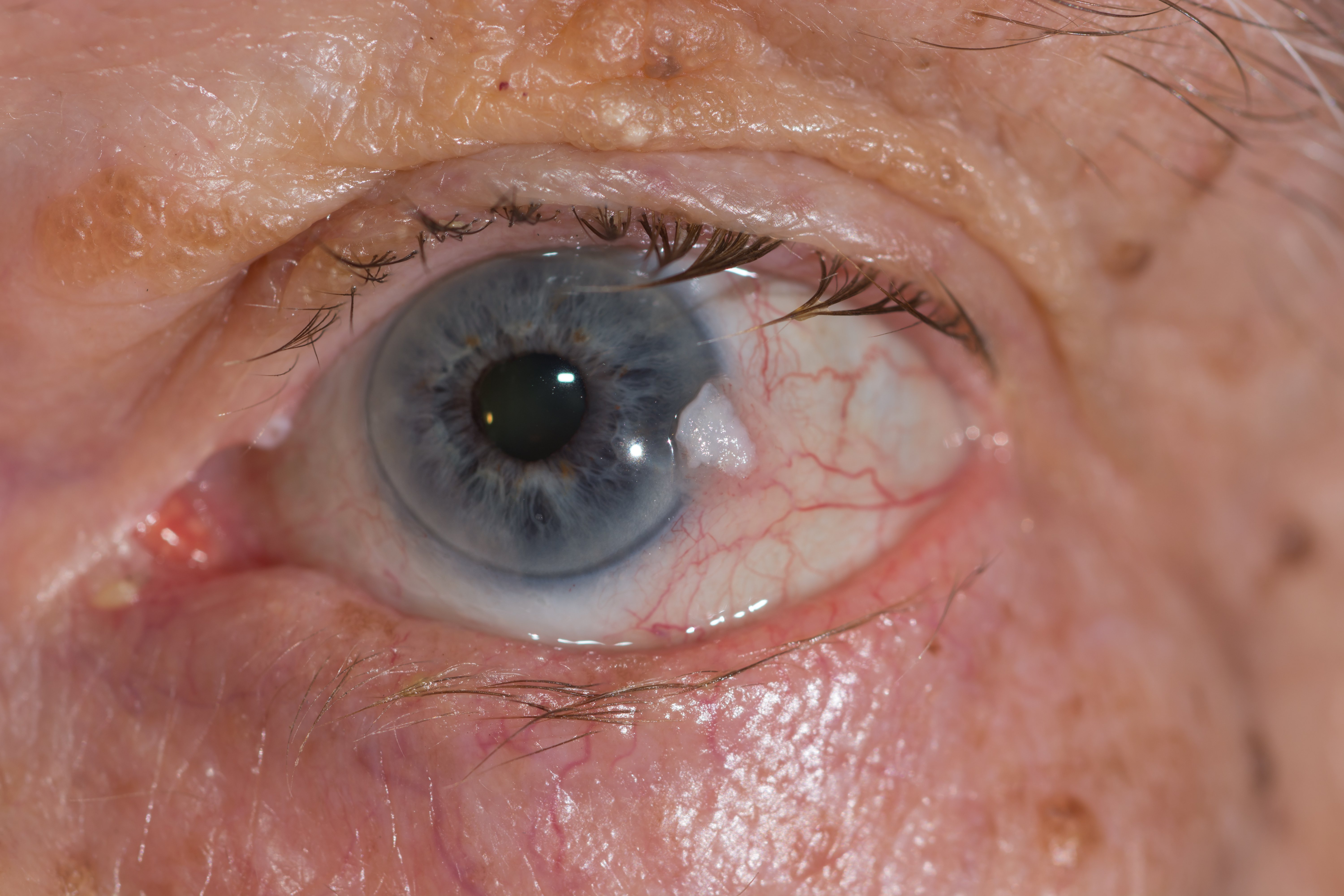 Cangrejo Raqueta Voluntario Cancer De Ojo Es Curable Quemado A Pesar De Cangrejo Raqueta Voluntario Cancer De Ojo Es Curable Quemado A Pesar De