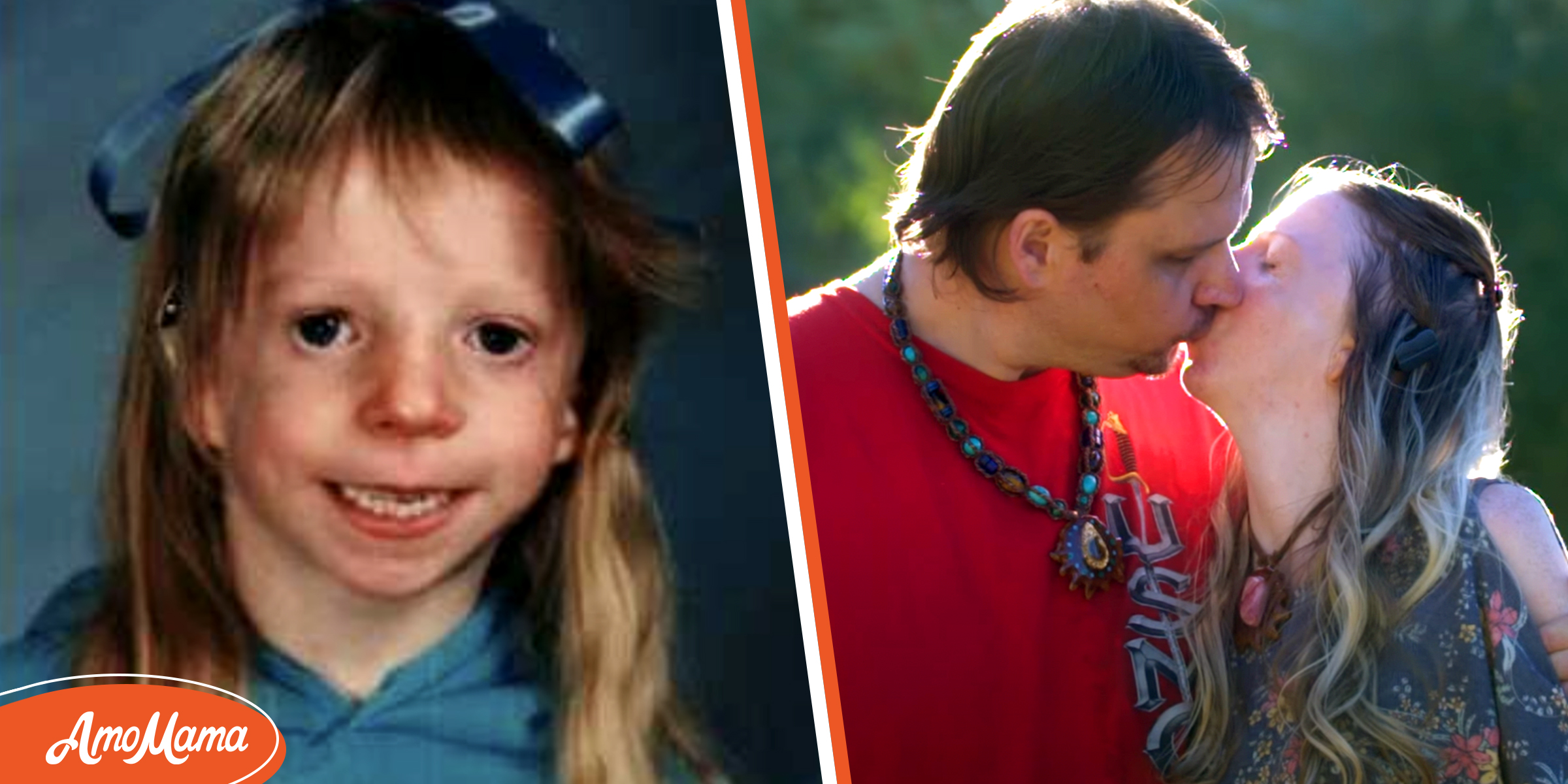 Man Marries Woman Called ‘Ugly’ for Deformed Face Yet 'Most Beautiful ...